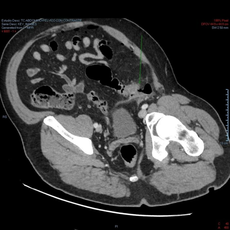 Divertículos | Diverticulitis y Cáncer de Colon [Click Aquí]