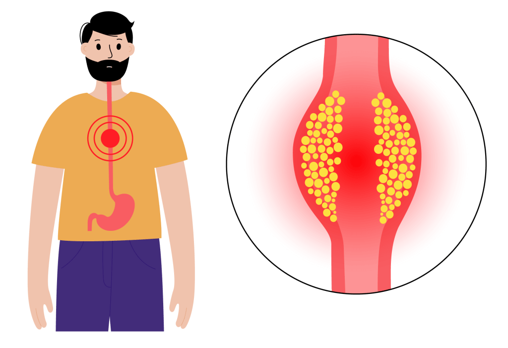 Cáncer de esófago del aparato digestivo en Madrid